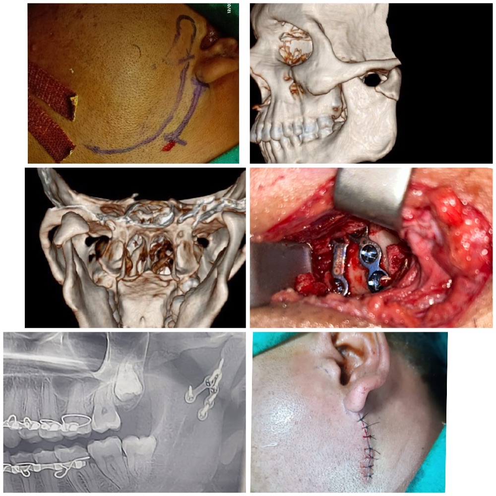 Condylar Fracture Surgery