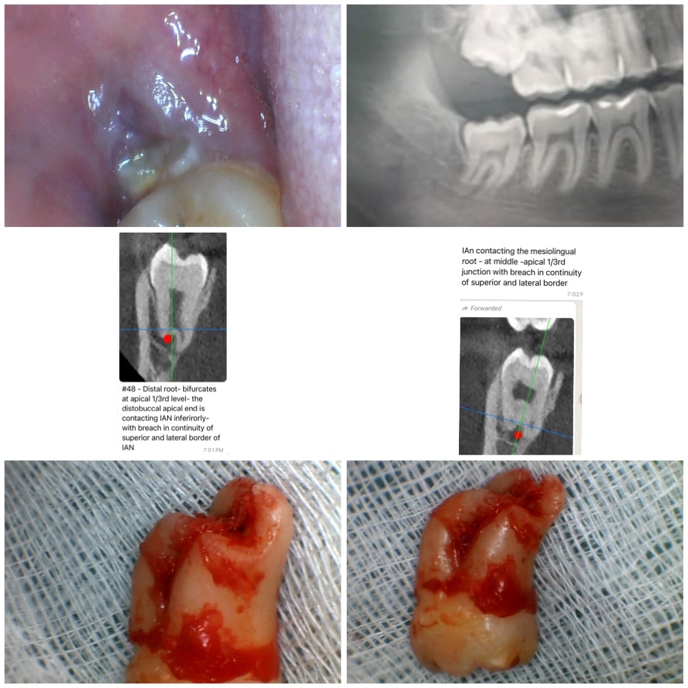Wisdom Tooth Surgery