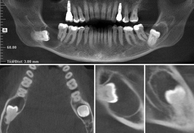 Jaw Cyst Enucleation